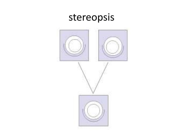 Strabismus and squint | PPT