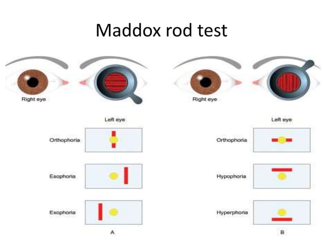 Strabismus and squint | PPT