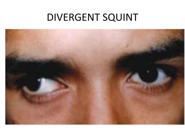 Strabismus and squint | PPT