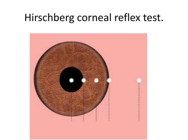 Strabismus and squint | PPT