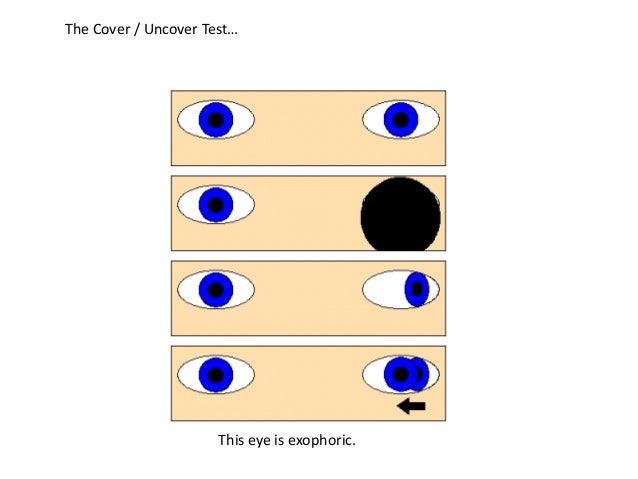 Strabismus assessment OSP