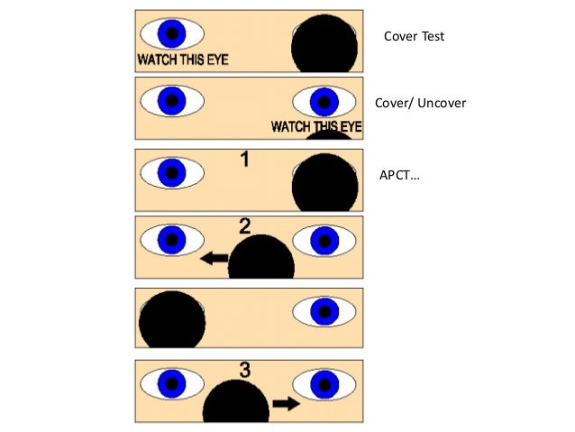 Strabismus assessment OSP