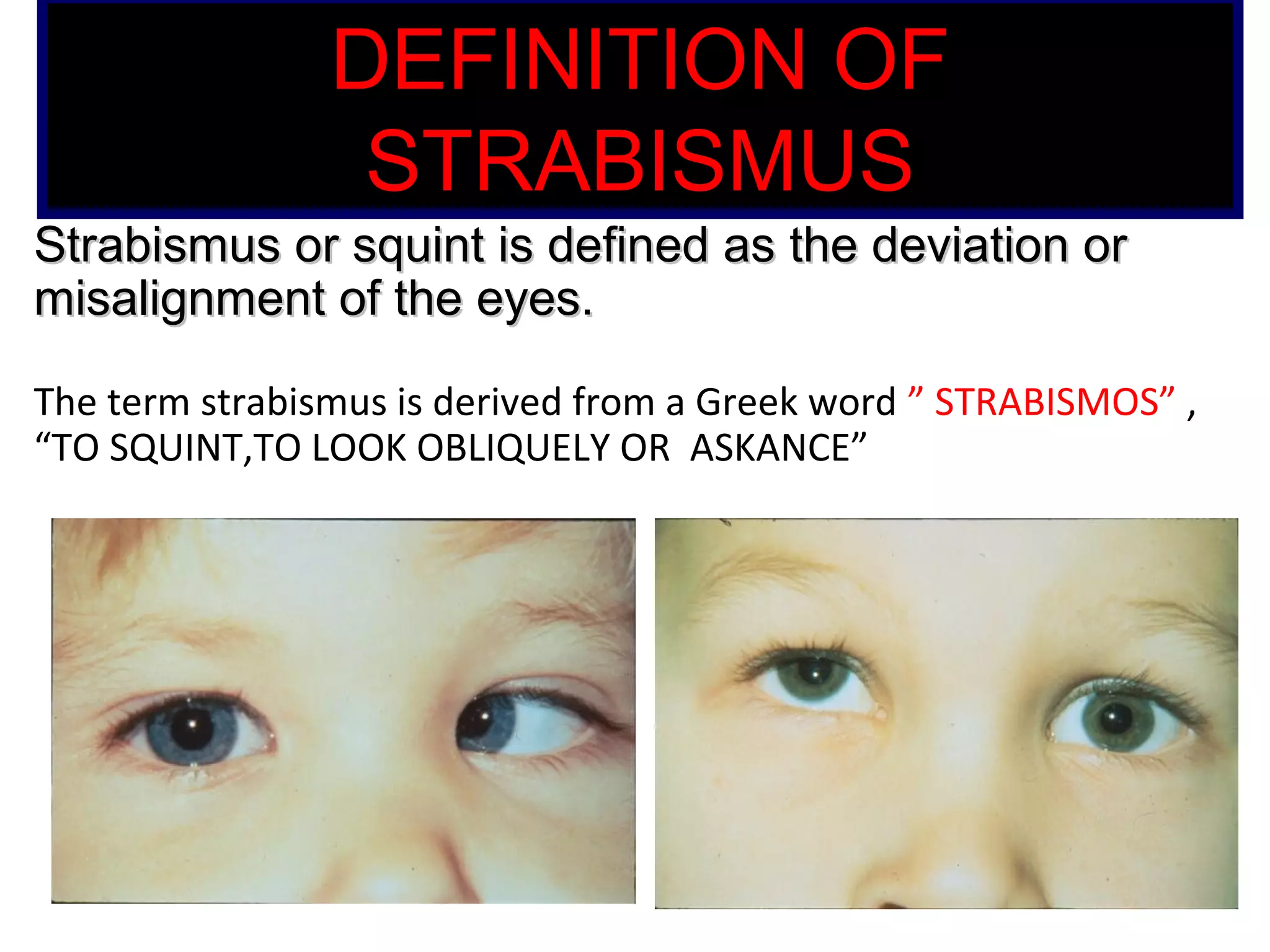 Strabismus by raju | PPT | Eye and Vision Conditions | Diseases and ...