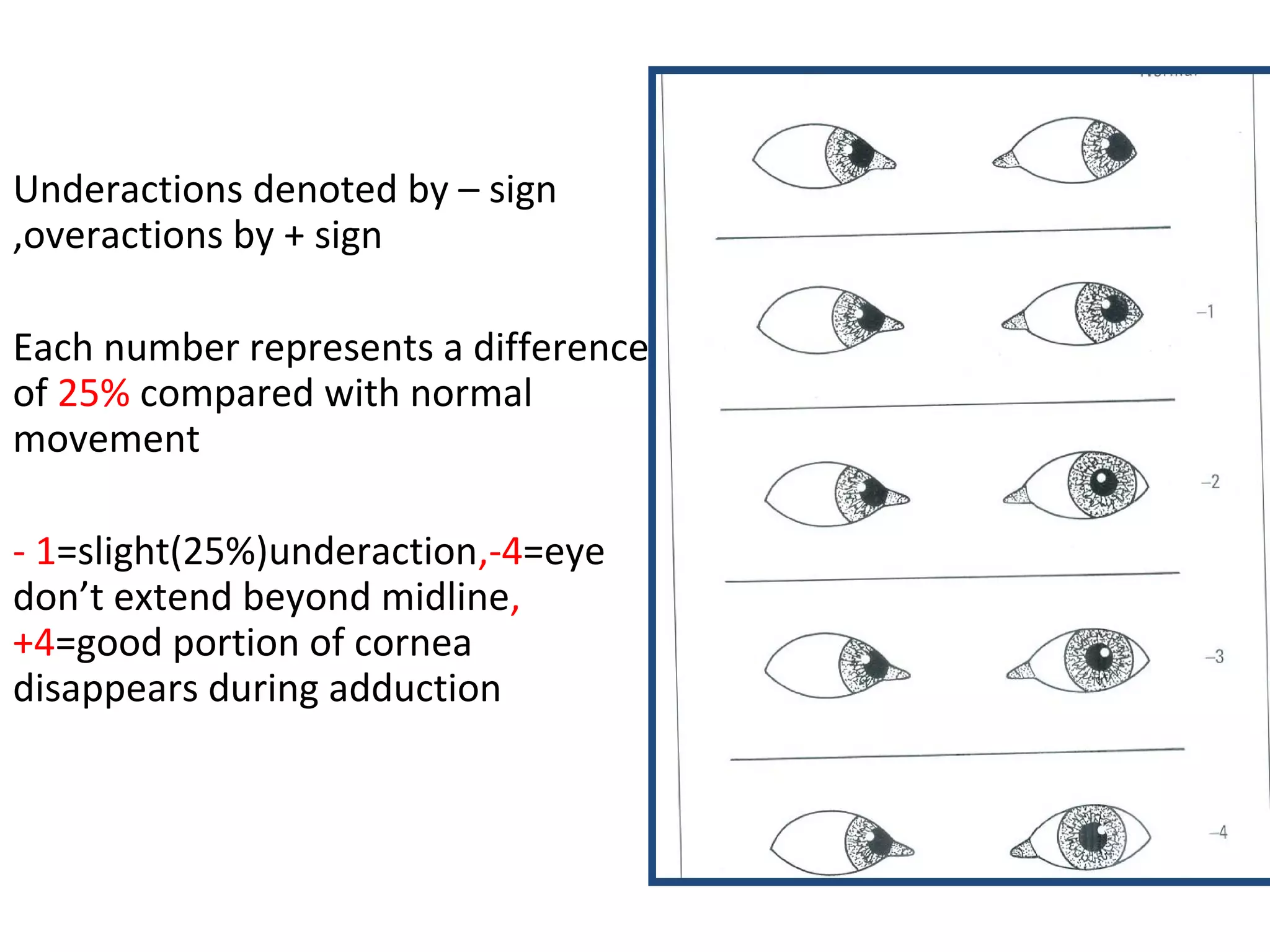 Strabismus by raju | PPT | Eye and Vision Conditions | Diseases and ...