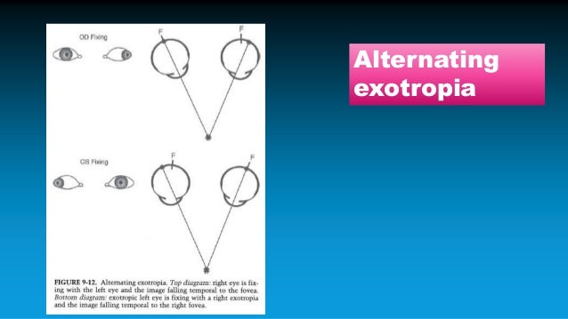 Strabismus demystified