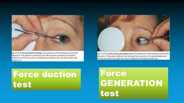 Strabismus demystified