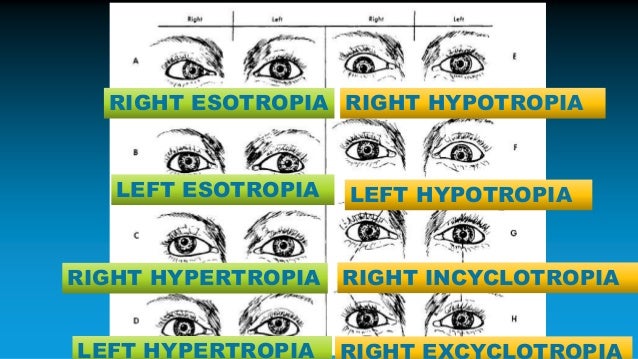 Strabismus demystified
