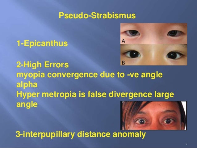 Strabismus stdents 2