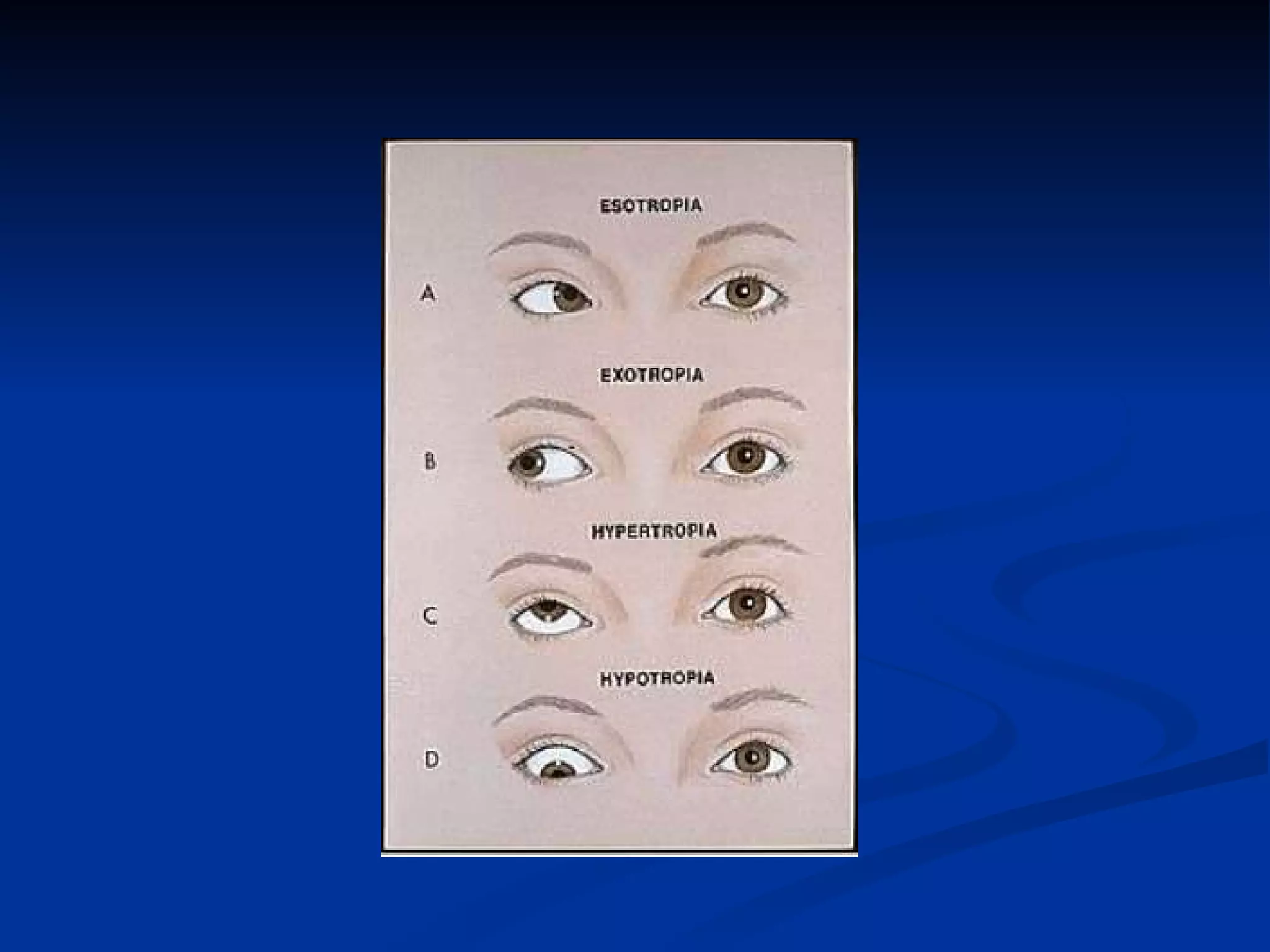 Strabismus | PPT