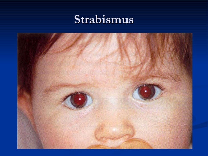 Strabismus