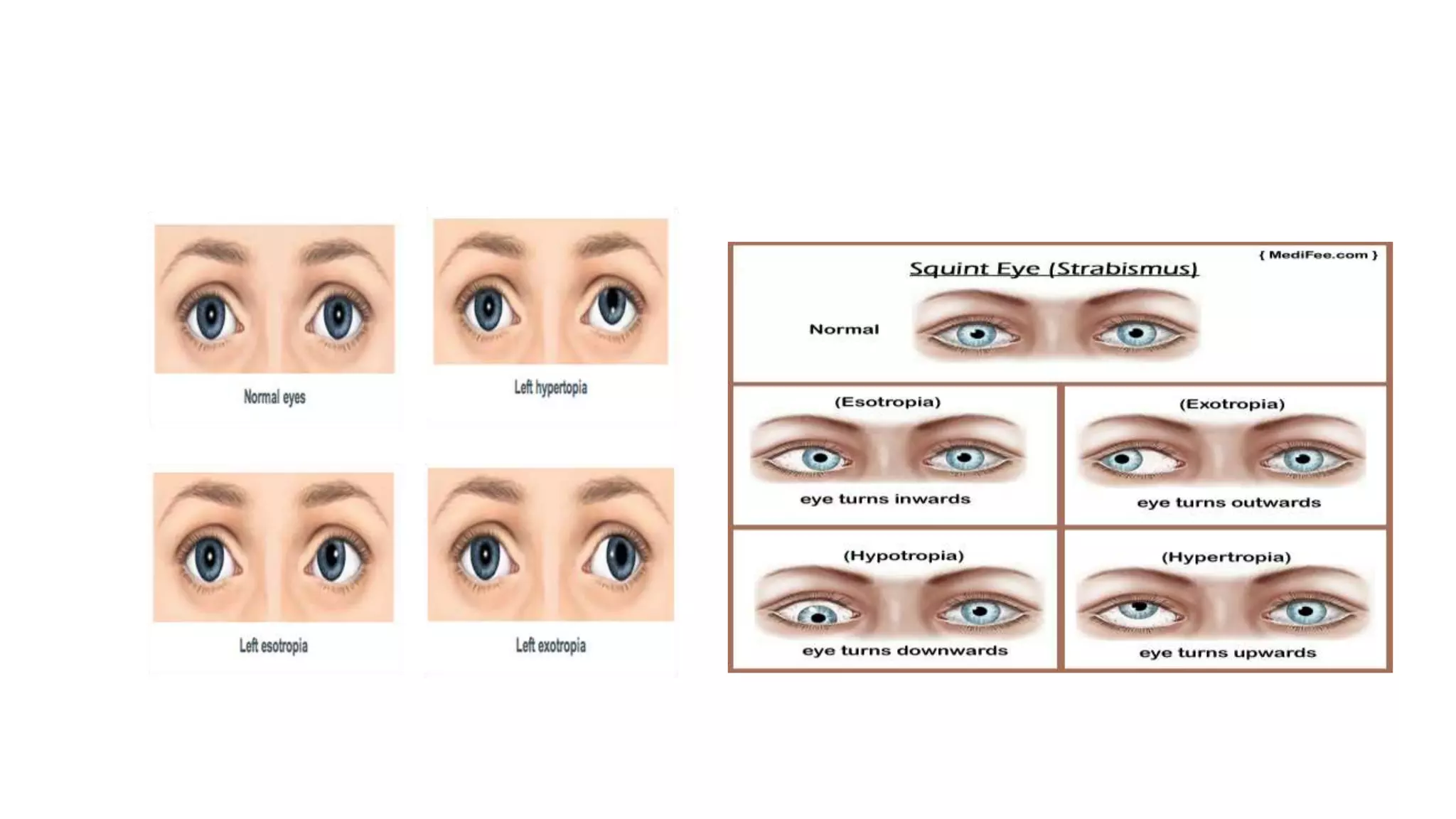 Strabismus o.a class | PPTX