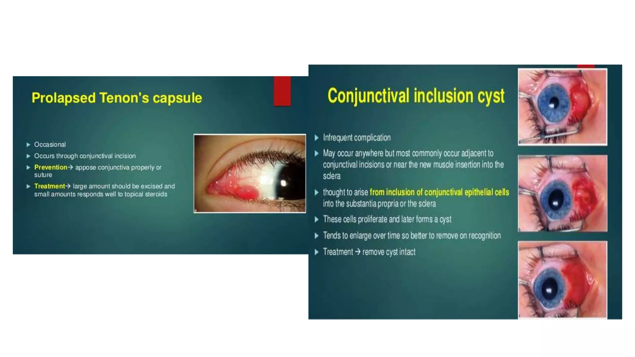 Strabismus o.a class | PPTX