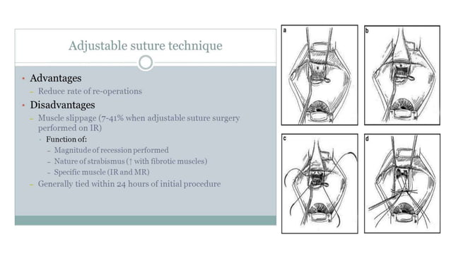 Strabismus o.a class | PPTX