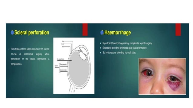Strabismus o.a class | PPTX