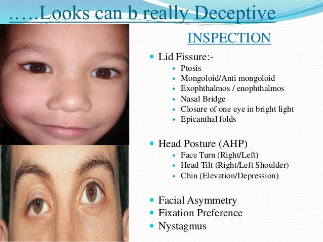 Strabismus patients evaluation