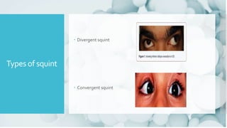 strabismus ppt.pptx