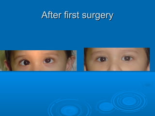 Strabismus surgery made simple: Dr. Madhu Karna Strabismologist | PPT