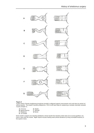 Strabismus Surgical Management of strabismus EHelveston.pdf