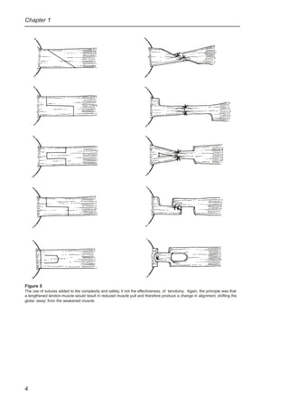 Strabismus Surgical Management of strabismus EHelveston.pdf