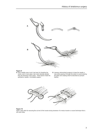 Strabismus Surgical Management of strabismus EHelveston.pdf