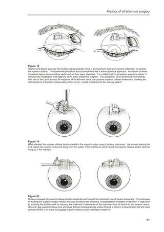 Strabismus Surgical Management of strabismus EHelveston.pdf