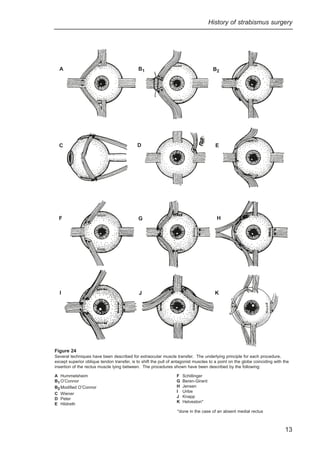 Strabismus Surgical Management of strabismus EHelveston.pdf