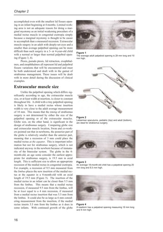 Strabismus Surgical Management of strabismus EHelveston.pdf