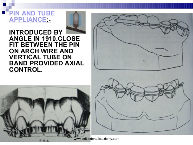 Straight wire appliance /certified fixed orthodontic courses by India…