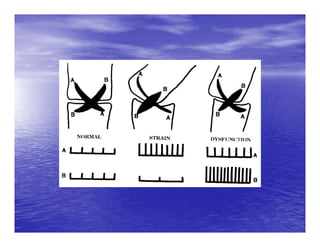 Strain counterstrain powerpoint | PDF