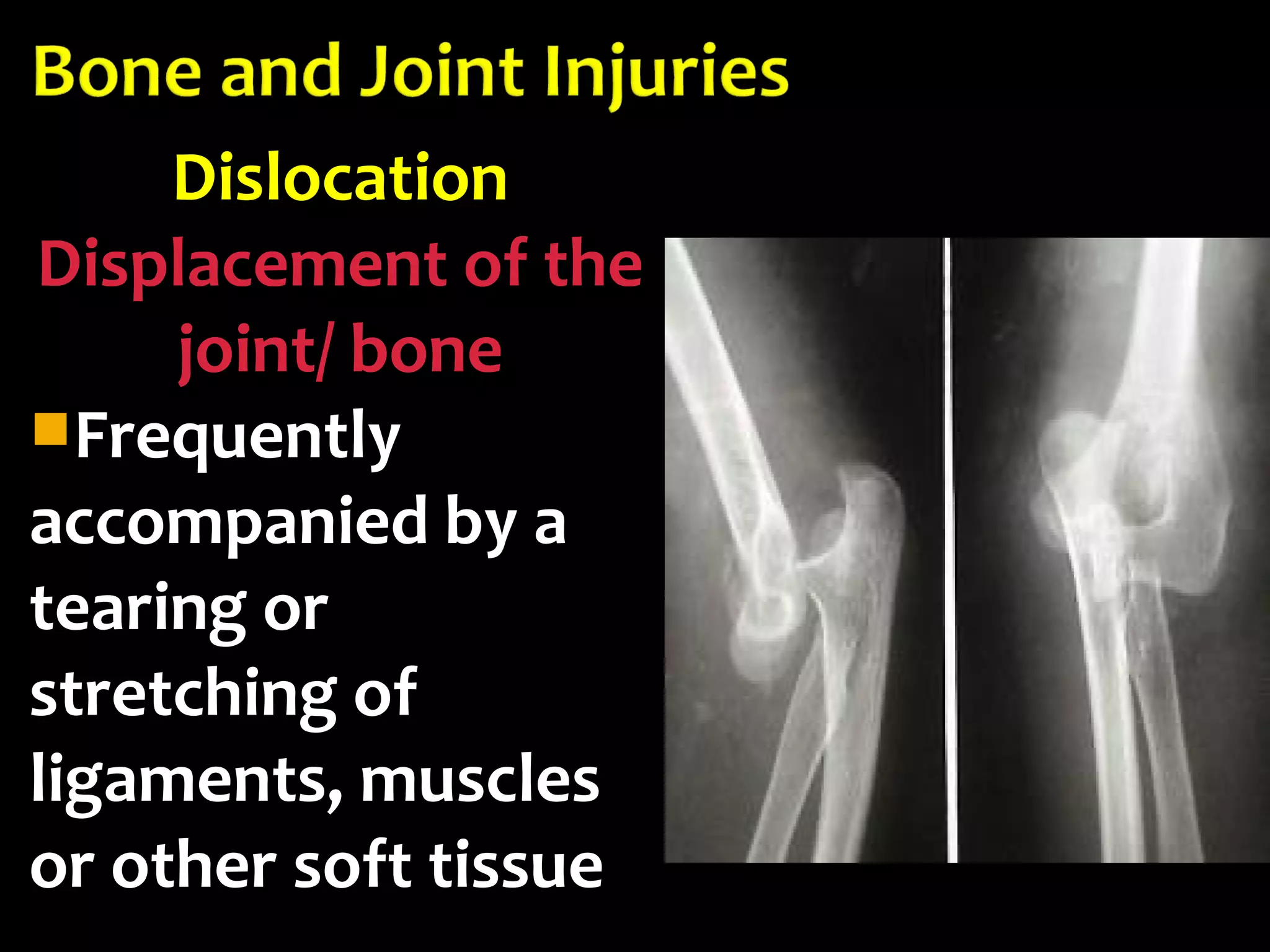 Strain sprain fracture | PPT