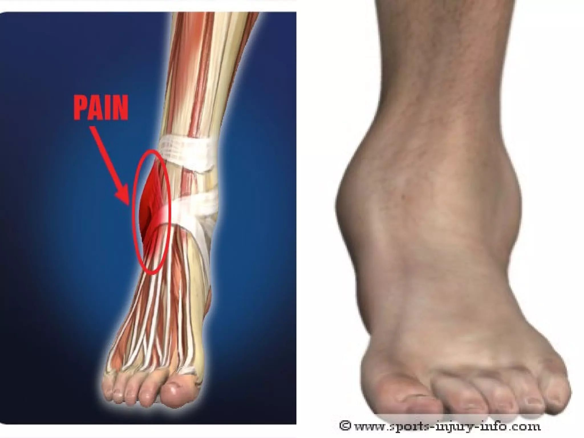 Strain sprain fracture | PPT