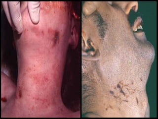 Strangulation | PPTX