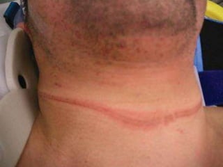 Manual Strangulation Marks