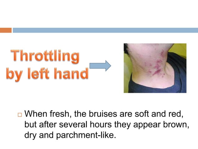 Strangulation | PPTX | Thyroid Disorders | Endocrine and Metabolic Diseases