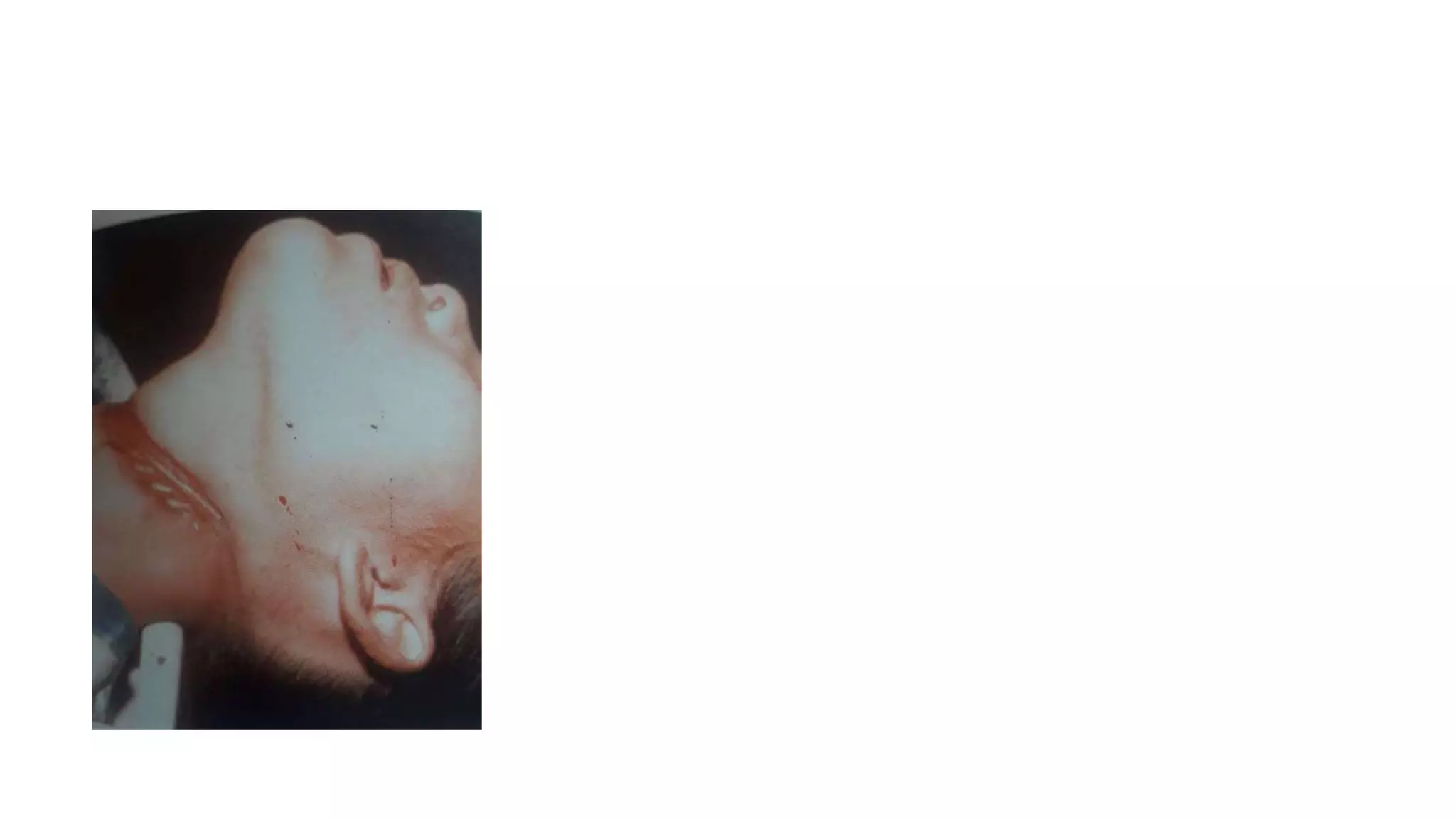 Strangulation by Faith Chelang'at | PPTX