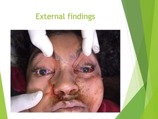 strangulation forensic medicine important.pptx