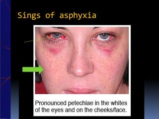Petechiae Eye Strangulation