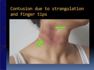 Manual Strangulation Marks