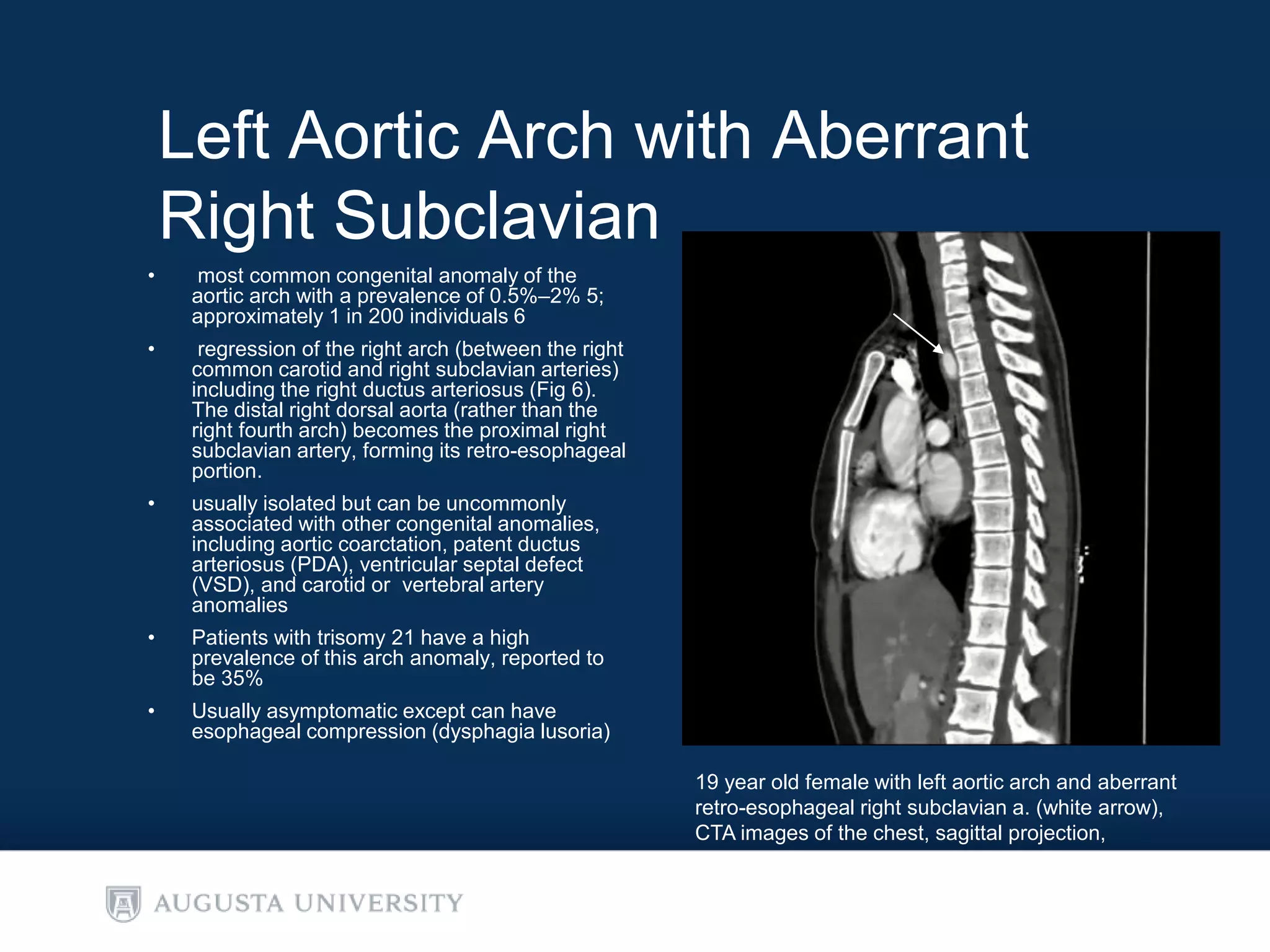Aortic Arches A REVIEW E POSTER | PPTX