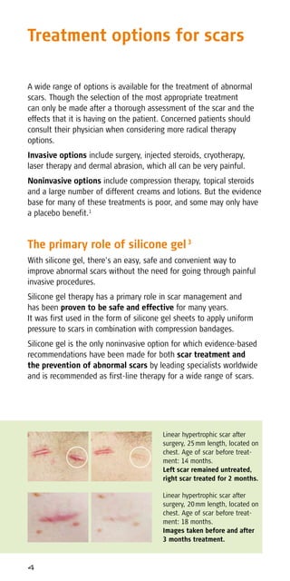 Strataderm - scar treatment and prevention with silicone | PDF