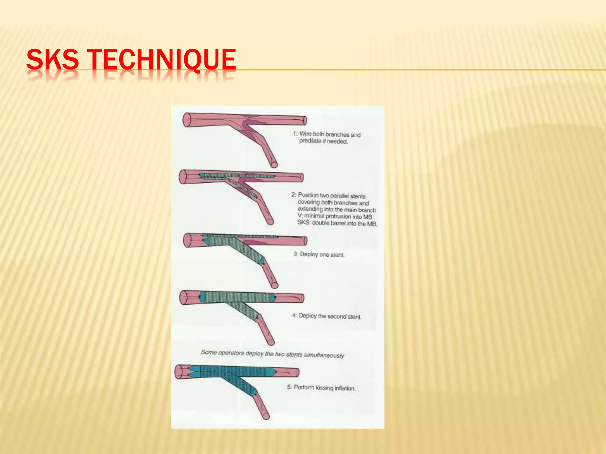 Strategies of handling side branch during pci | PPTX