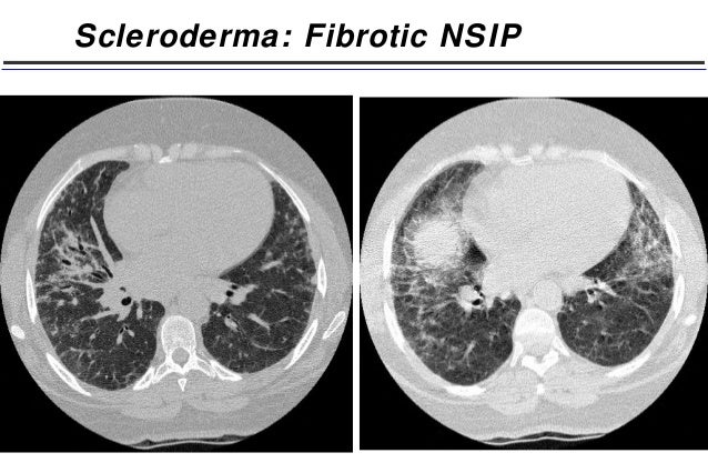 Scleroderma: State of the Art Management