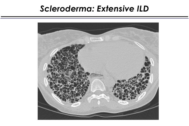 Scleroderma: State of the Art Management