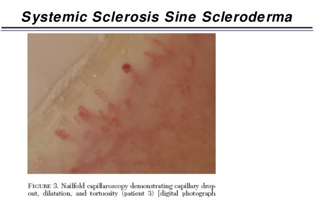 Scleroderma: State of the Art Management
