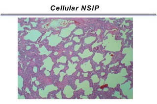 Update on Scleroderma and the Lung | PPT