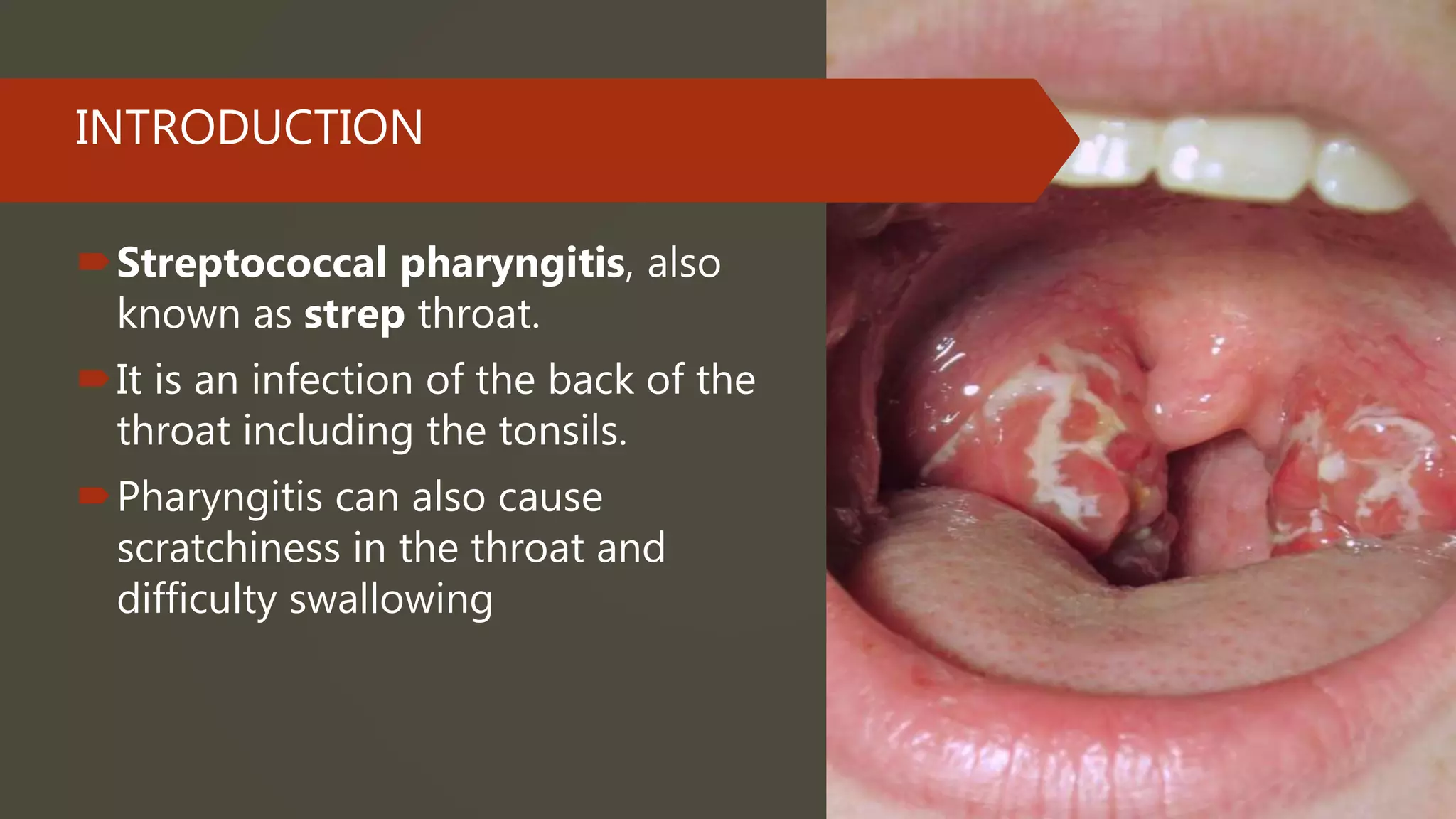 Streptococcal Phayryngitis by Asnad khan | PPTX | Ear, Nose and Throat Conditions | Diseases and ...