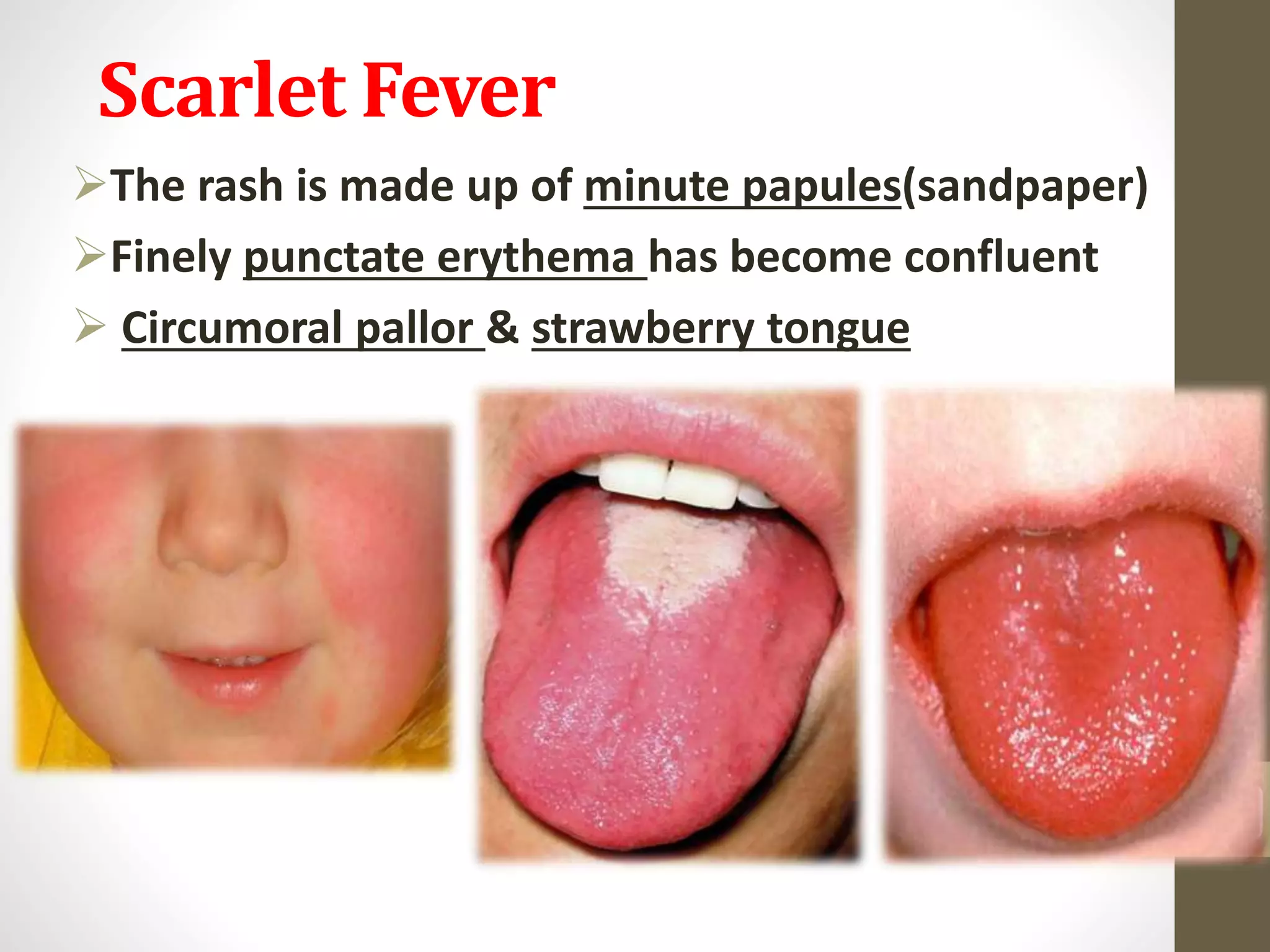 Streptococcal infections | PPSX