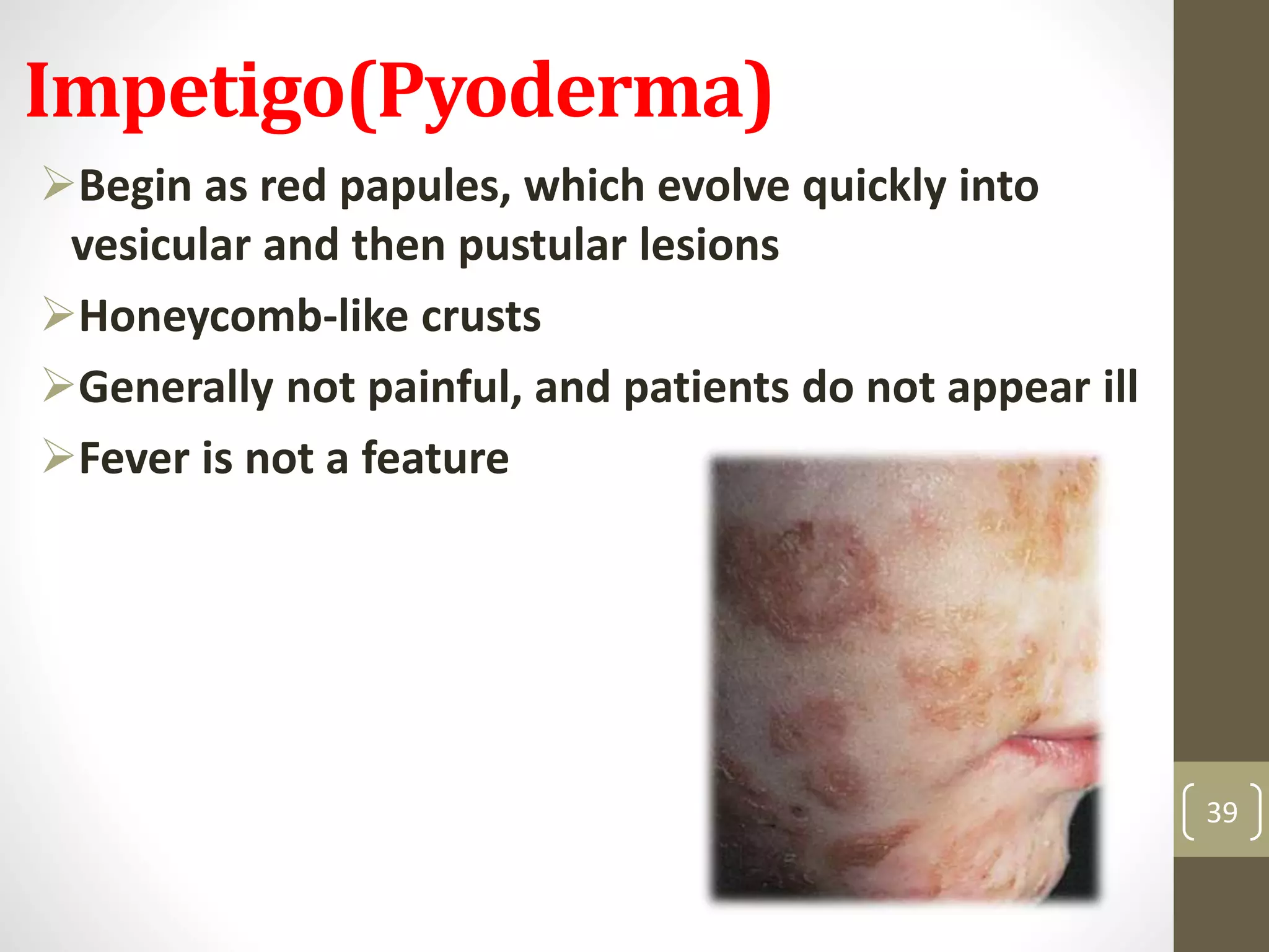 Streptococcal infections | PPSX