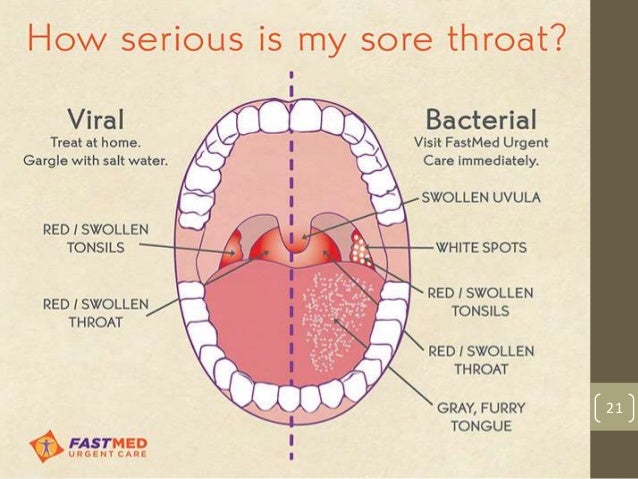 Streptococcal infections