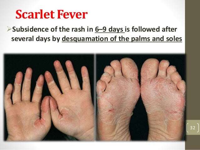 Streptococcal infections